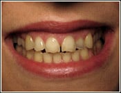 Full Mouth Reconstruction – Kurpis Center For Advanced Dentistry ...