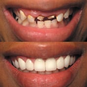 Full Mouth Reconstruction – Kurpis Center For Advanced Dentistry ...