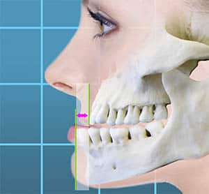 Underbite Correction in 2 Visits Without Jaw Surgery - Kurpis Center ...